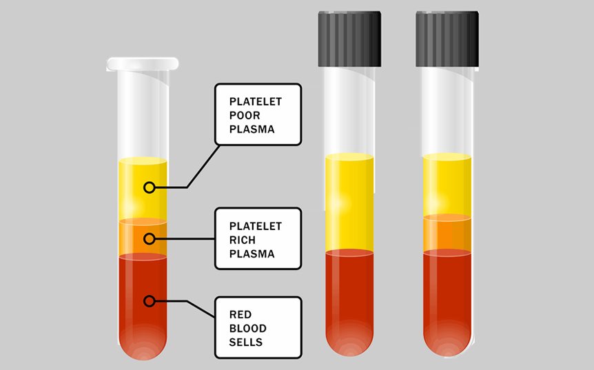 PRP therapy FAQs - Mr Michael Moss