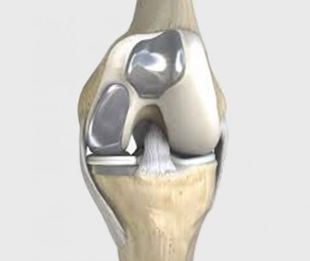Inner (Medial) Partial Knee Replacement - Half Knee Replacement - Uni